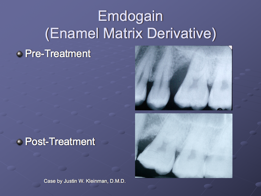 Guided Bone & Tissue Regeneration in Westminster MD | Save Your Teeth