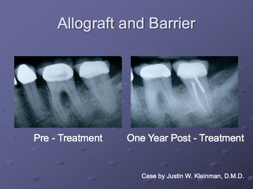 Guided Bone & Tissue Regeneration in Westminster MD | Save Your Teeth
