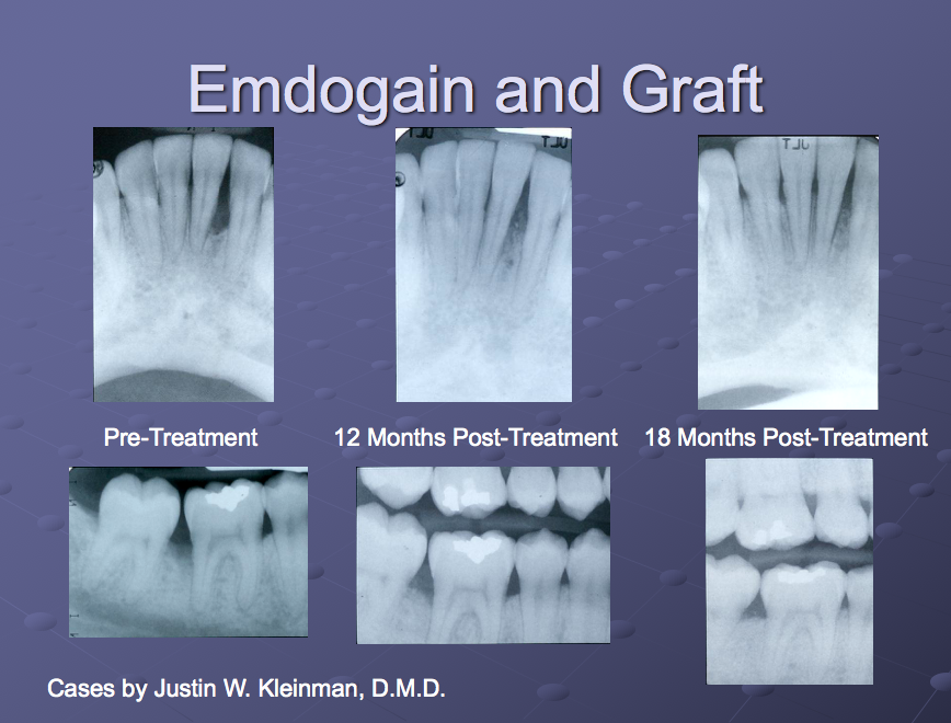 Guided Bone & Tissue Regeneration in Westminster MD | Save Your Teeth