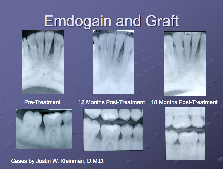 Guided Bone & Tissue Regeneration in Westminster MD | Save Your Teeth