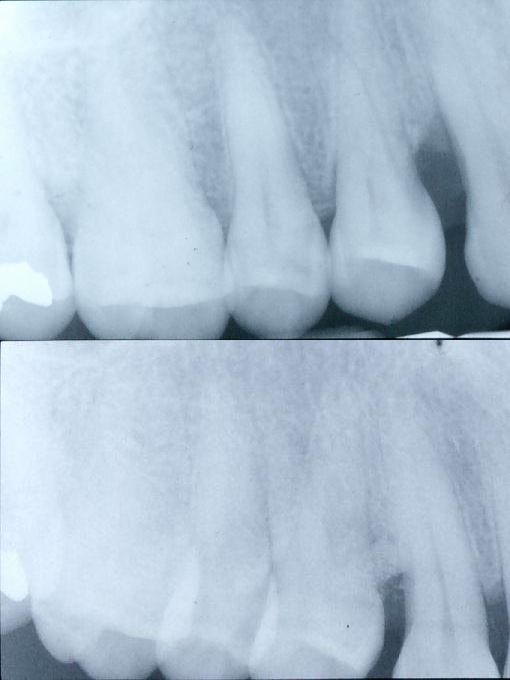 Guided Bone & Tissue Regeneration in Westminster MD | Save Your Teeth