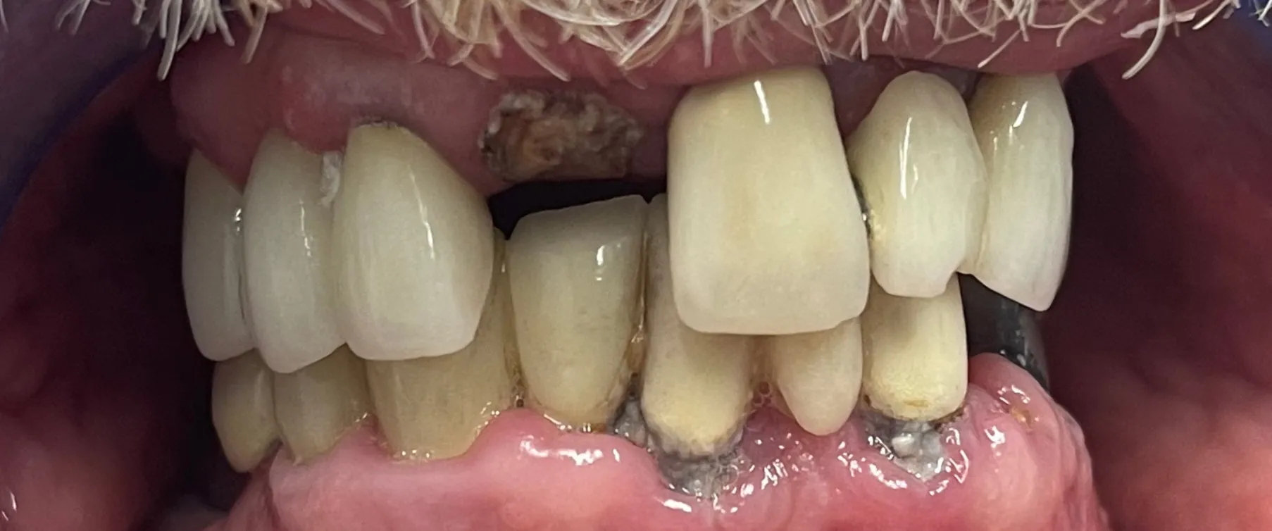 All on 4 Dental Implants Westminster | Same Day Dental Implants Carroll ...